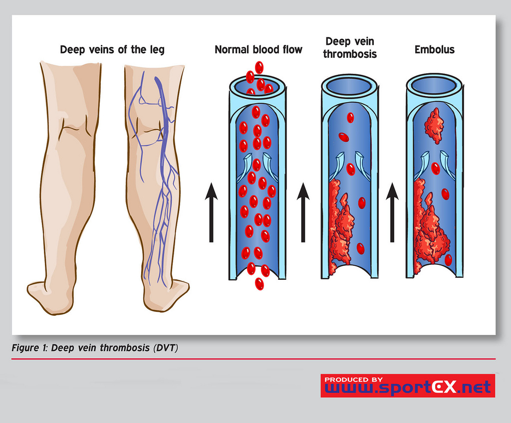 IVC Filters – a life-threatening medical device