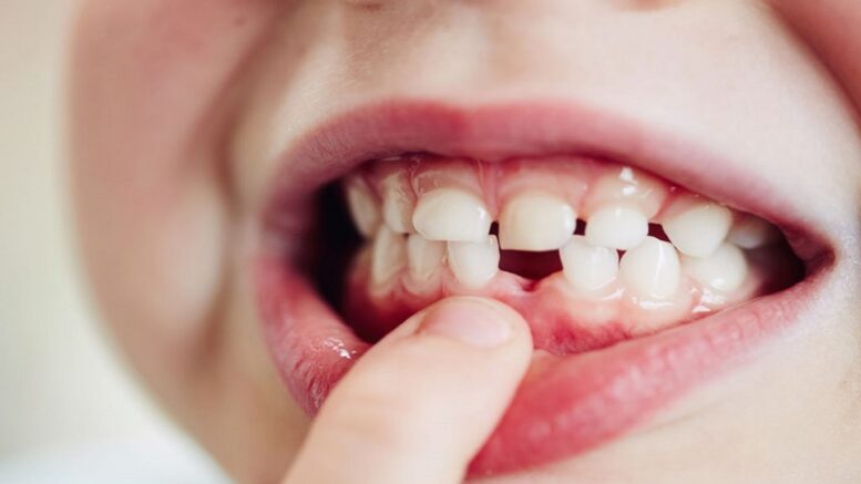 Your Complete Guide to Overbite: Causes, Health Risks, & Treatments
