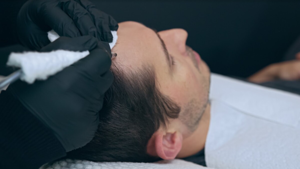 Scalp Micropigmentation: Preparation And Aftercare