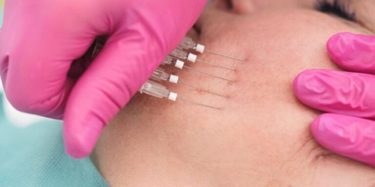 Mono Threads: A Non-Surgical Method For Skin Rejuvenation