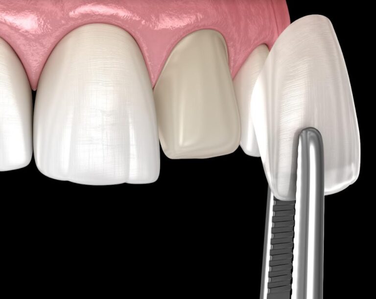 Ceramic Implant Dentistry: A Guide to the Future of Tooth Replacement
