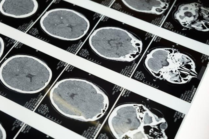 Early Neurological Rehabilitation: Giving Brain and Spinal Recovery the ...